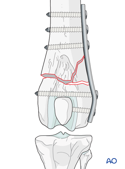 Bridging plate for Extra-articular fracture, wedge