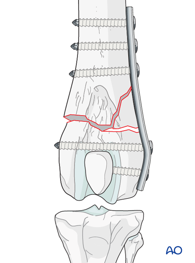 Bridging plate for Extra-articular fracture, wedge
