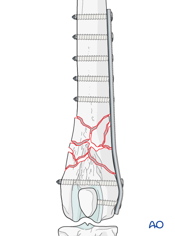 Lag screw and neutralization plate for Extra-articular fracture, complex