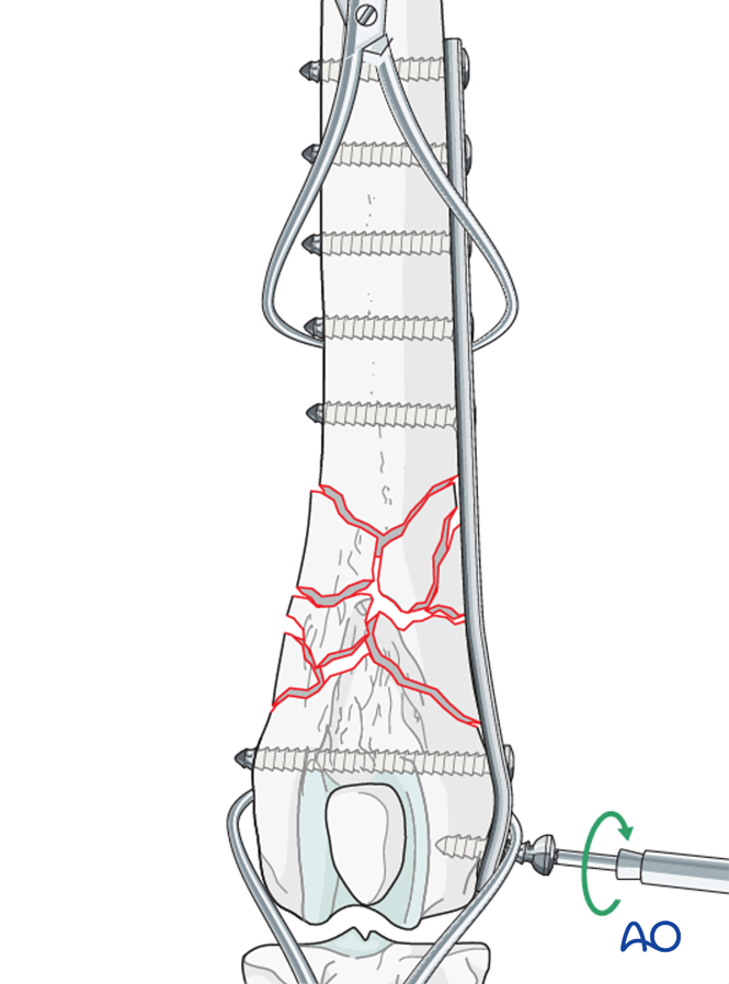 Bridging plate for Extra-articular fracture, complex