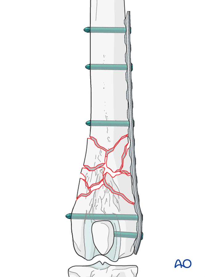 Bridging plate for Extra-articular fracture, complex