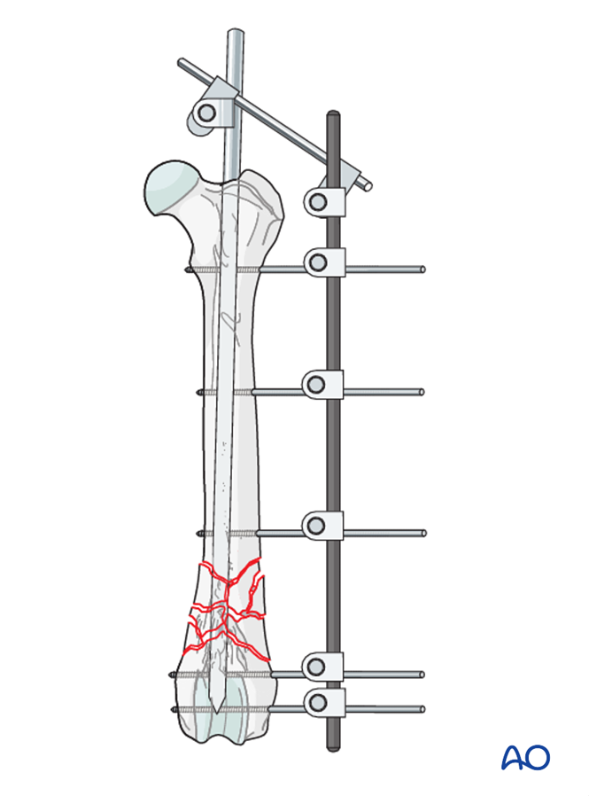 External skeletal fixator for Extra-articular fracture, complex