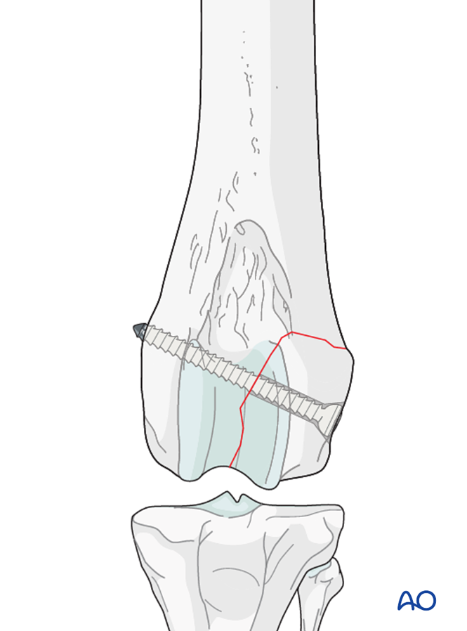 Screw fixation for Partial articular fracture, lateral condyle, sagittal