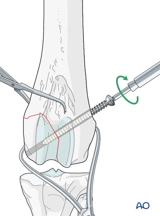 Screw fixation for Partial articular fracture, medial condyle, sagittal