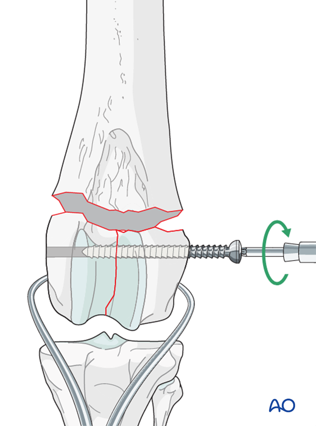 Cross pinning and transcondylar lag screw for Complete articular ...