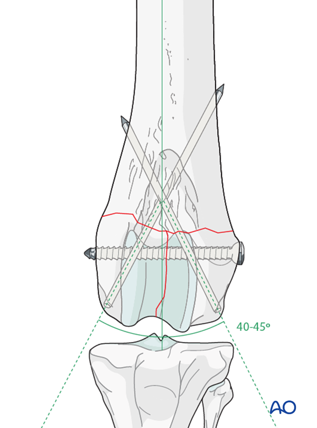Cross pinning and transcondylar lag screw for Complete articular ...