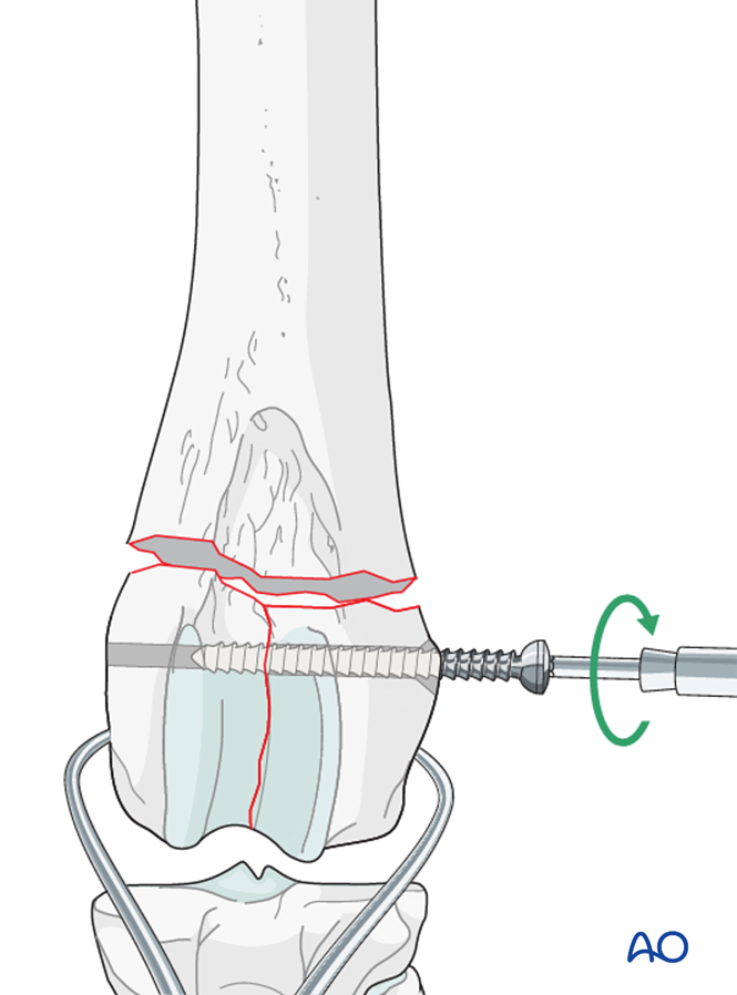 Transcondylar lag screw and neutralization plate for Complete articular ...