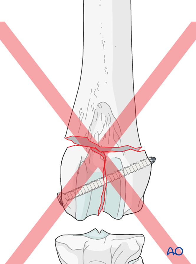 Cross pinning and transcondylar lag screw for Complete articular ...