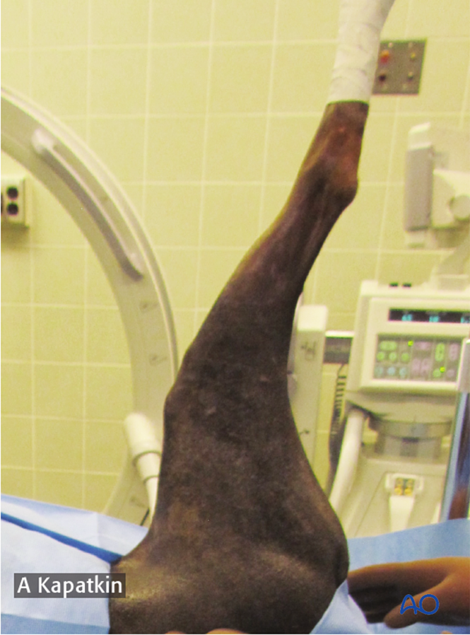 Dorsal recumbency position