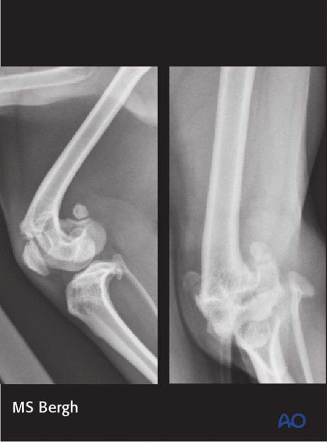 Complications in distal femoral fractures
