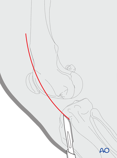 Lateral parapatellar approach