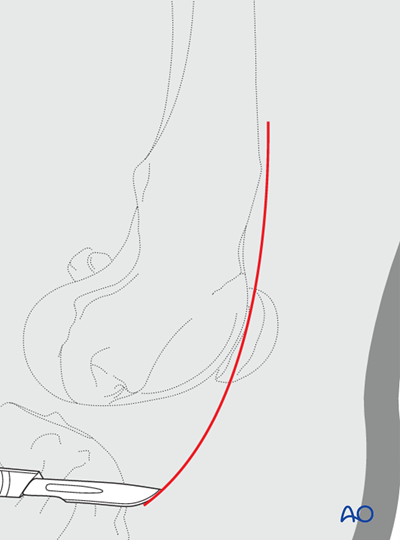 Medial parapatellar approach to the cat patella