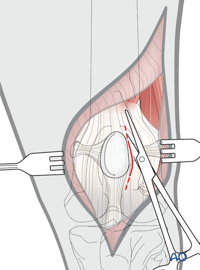 Lateral parapatellar approach to the dog patella