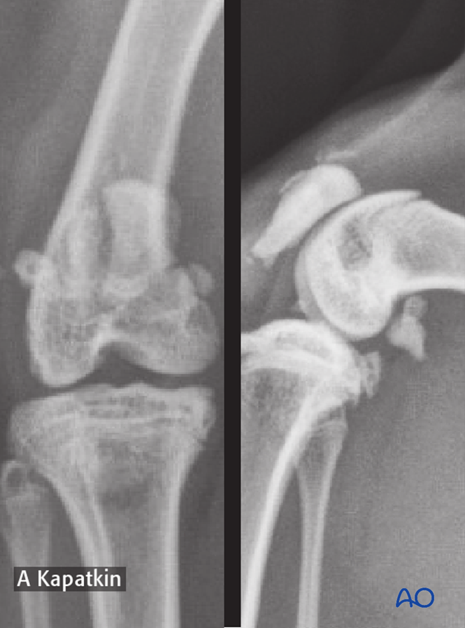 Longitudinal fracture