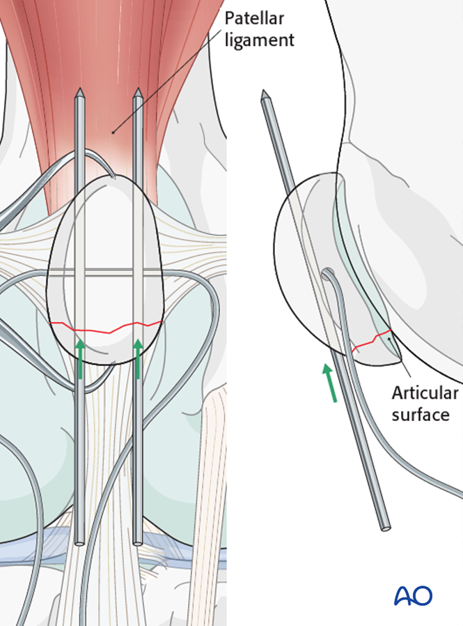 Tension band and K-wires for Avulsion fracture (distal and proximal)