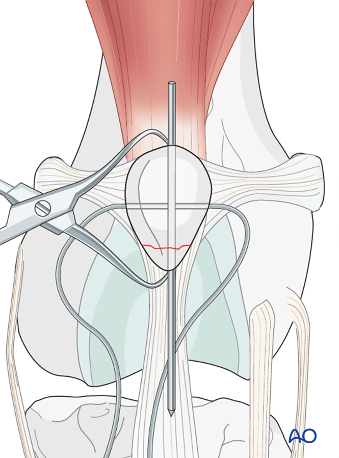 Tension band and K-wires for Avulsion fracture (distal and proximal)
