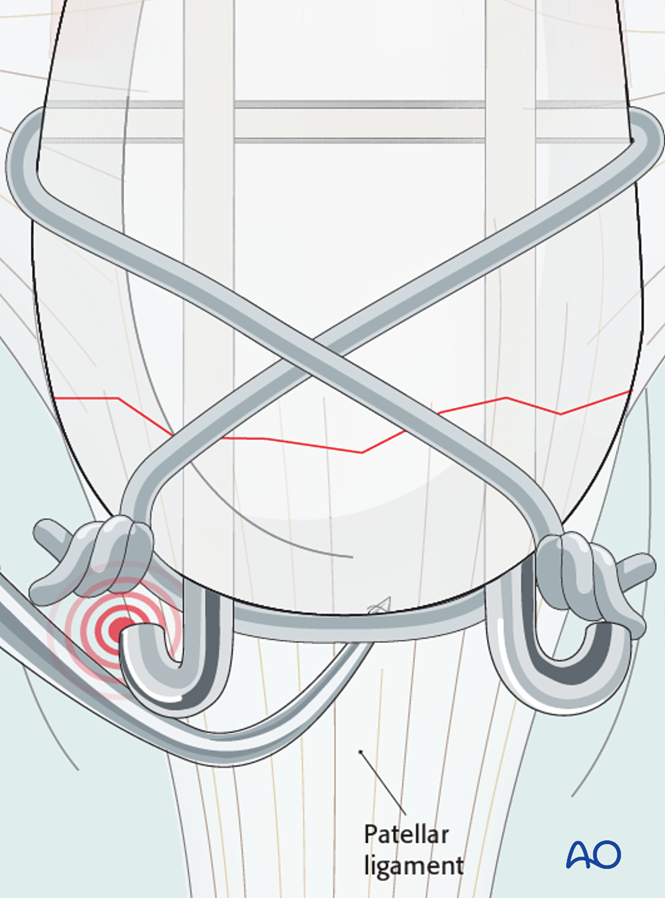 Tension band and K-wires for Avulsion fracture (distal and proximal)