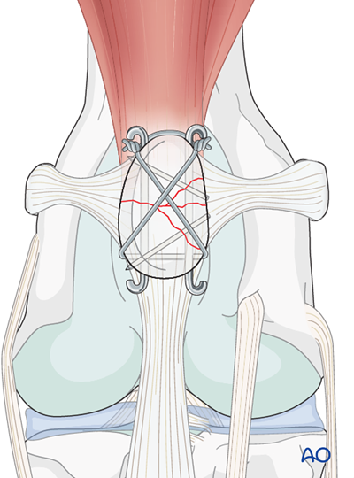 Tension band wiring for Comminuted fracture