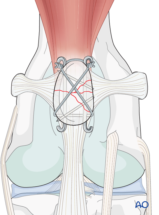 Tension band wiring for Comminuted fracture