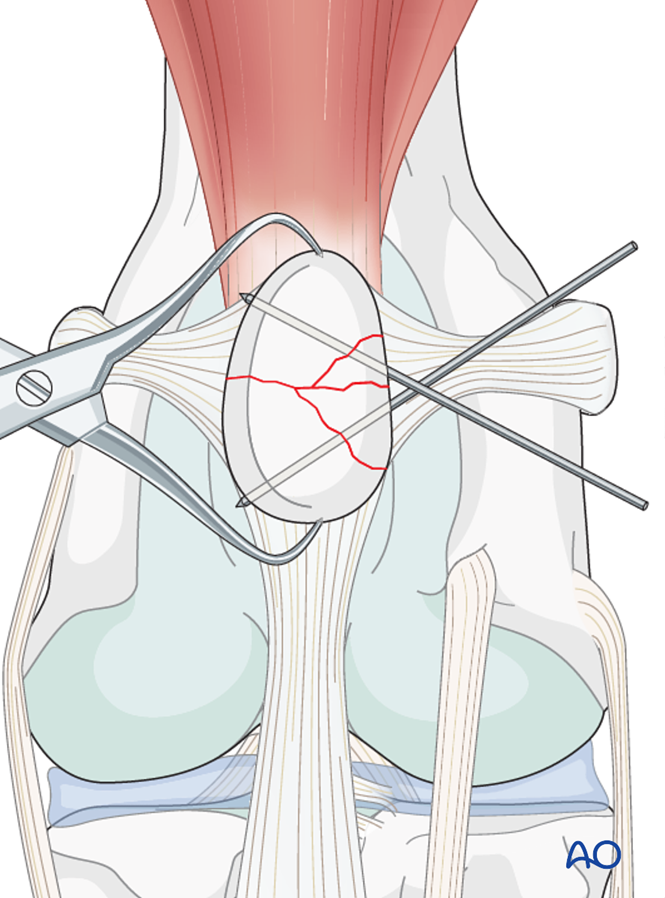 Tension band wiring for Comminuted fracture