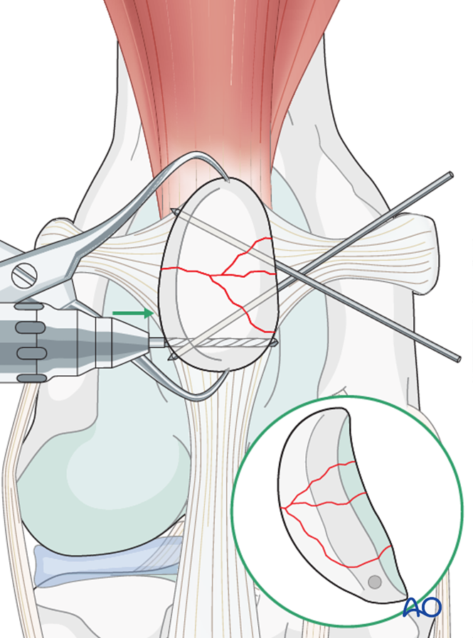 Tension band wiring for Comminuted fracture