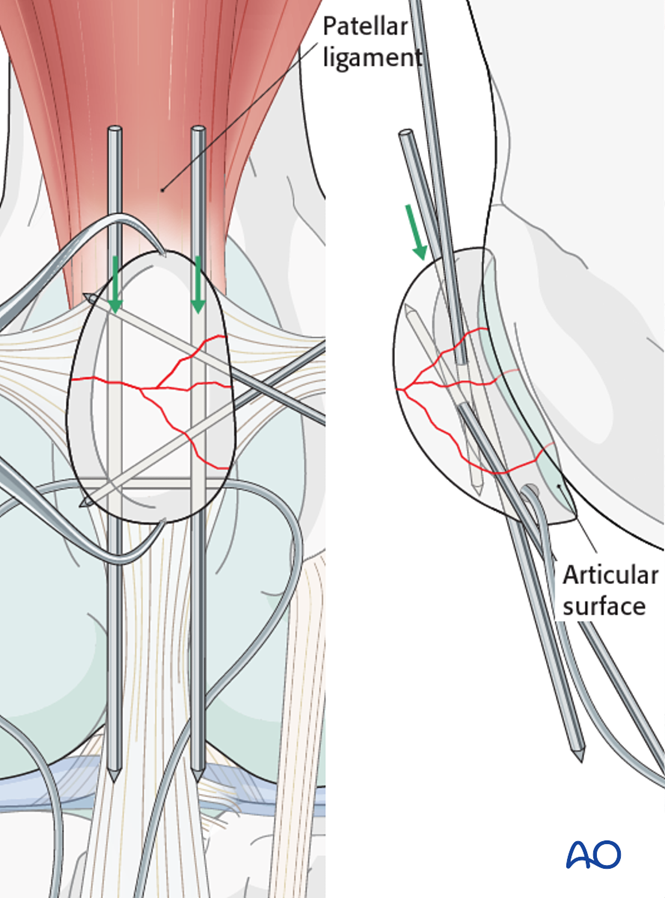 Tension band wiring for Comminuted fracture