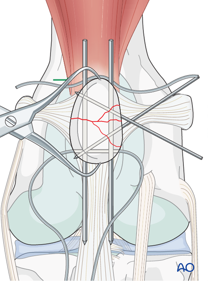 Tension band wiring for Comminuted fracture