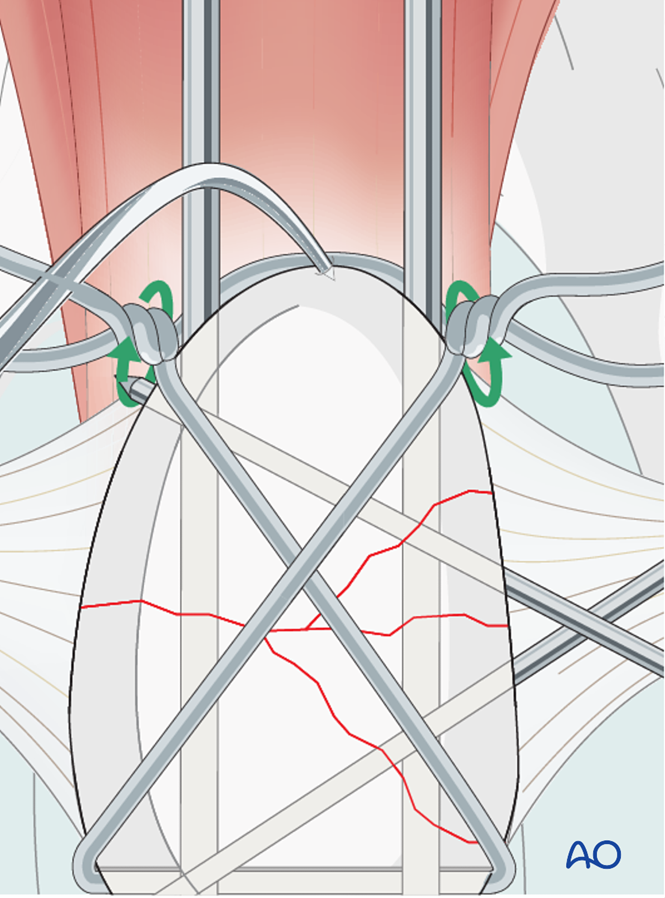 Tension band wiring for Comminuted fracture
