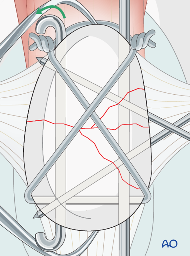 Tension band wiring for Comminuted fracture