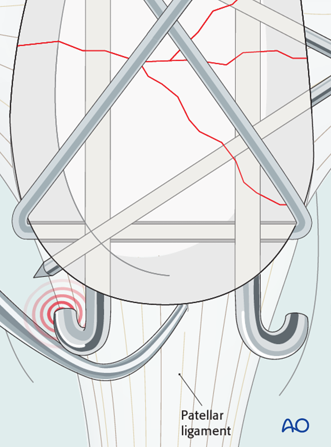 Tension band wiring for Comminuted fracture