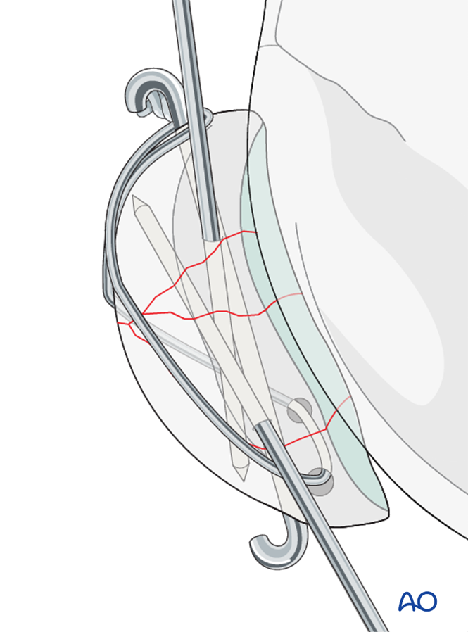 Tension band wiring for Comminuted fracture