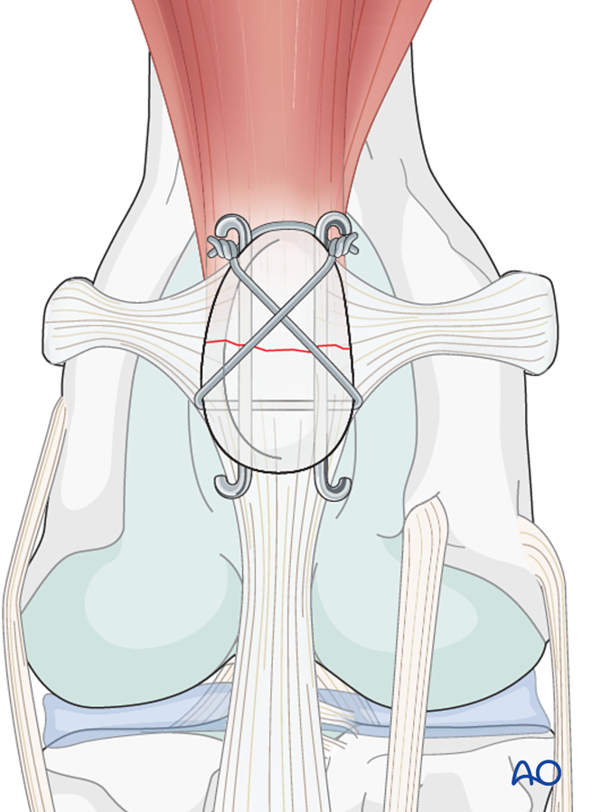 Tension band wiring for Transverse fracture