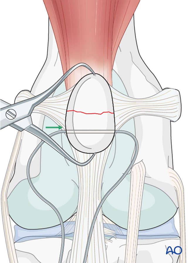 Tension band wiring for Transverse fracture