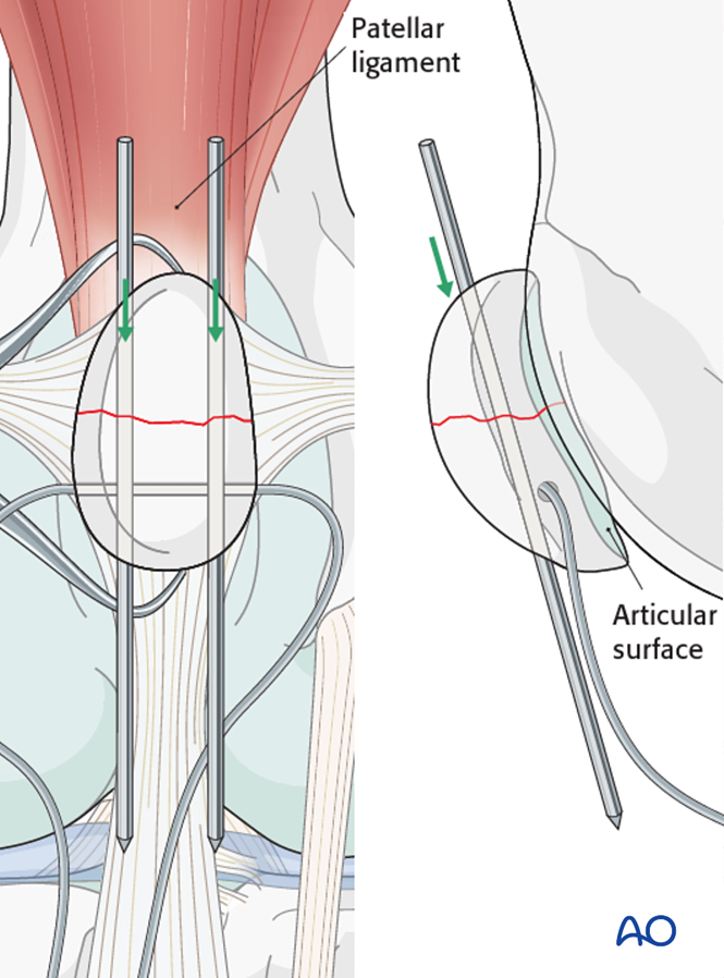 Tension band wiring for Transverse fracture