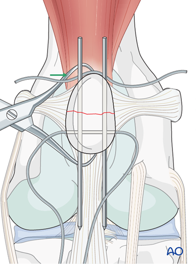 Tension band wiring for Transverse fracture