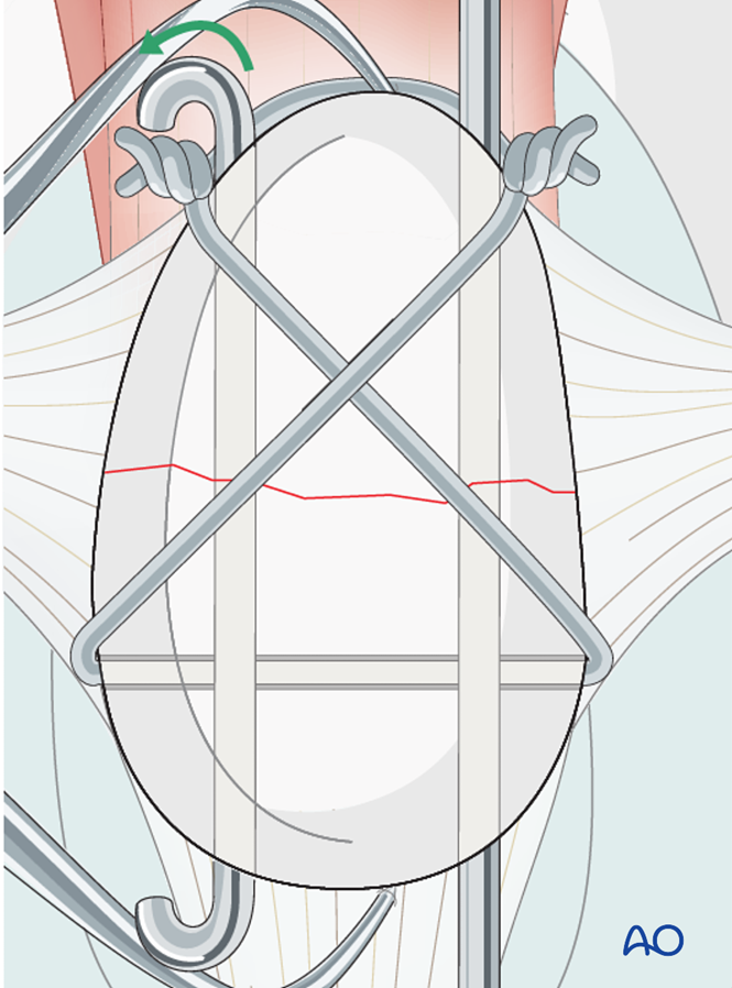 Tension band wiring for Transverse fracture