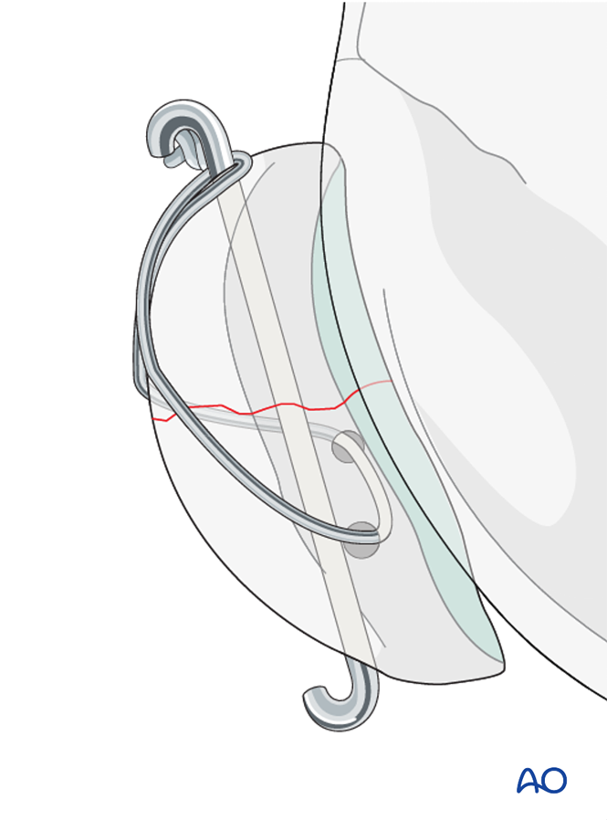 Tension band wiring for Transverse fracture