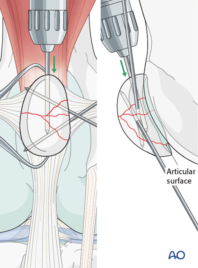 K-wire and figure of 8 technique for Comminuted fracture