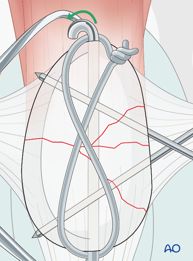 K-wire and figure of 8 technique for Comminuted fracture