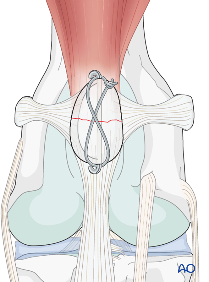 K-wire and figure of 8 technique for Transverse fracture