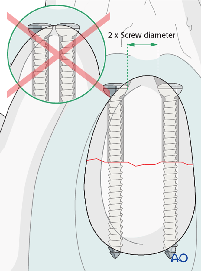 Lag screw fixation
