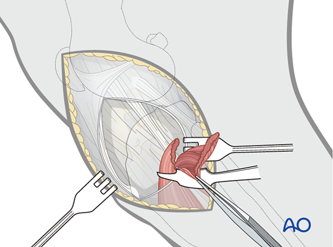 Craniolateral approach to the proximal tibia