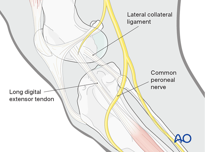 Craniolateral approach to the proximal tibia