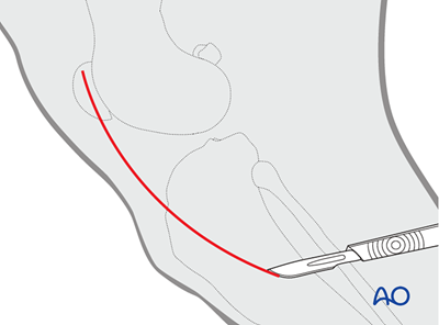 Craniolateral approach to the proximal tibia