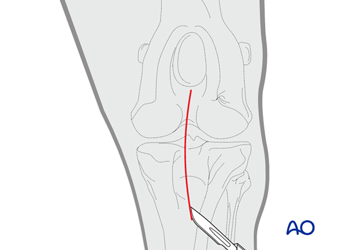Cranial approach to the dog proximal tibia