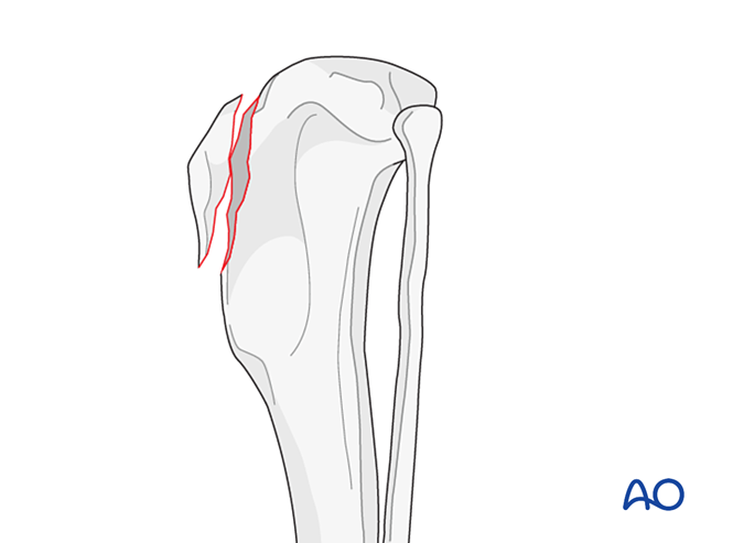 Avulsion fracture