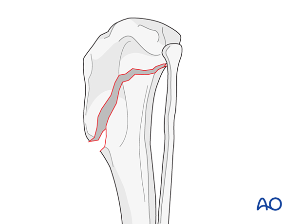 Simple extraarticular fracture