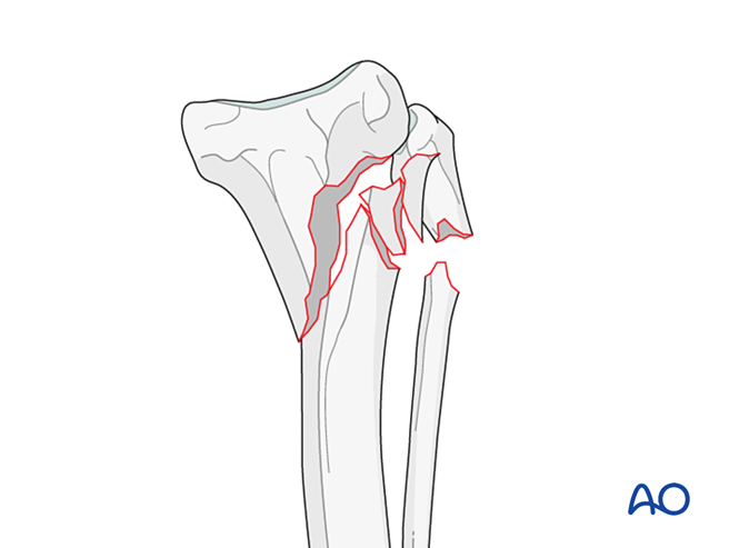 Multifragmentary extraarticular fracture