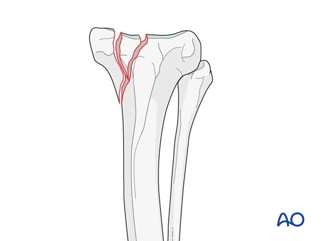 Multifragmentary partial articular unicondylar fracture