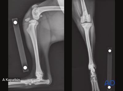 Avulsion fracture